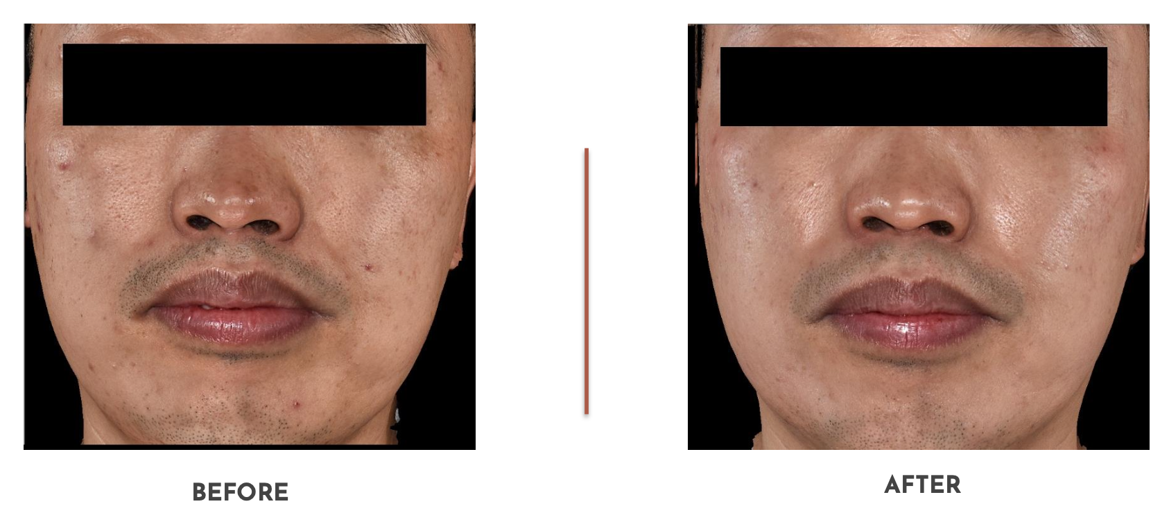 PicoLo (Pico Laser) - Phi MD