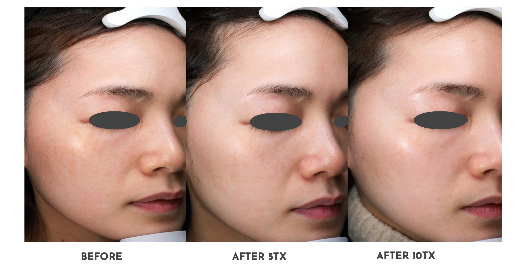 PicoLo (Pico Laser) - Phi MD